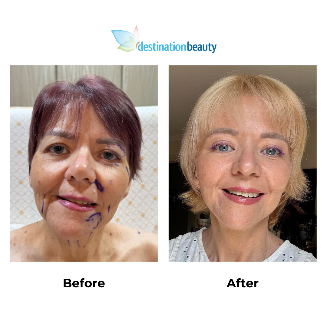Tania had facelift and skin removal surgery in Thailand Tania had facelift and skin removal surgery in Thailand